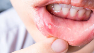 ¿Por qué aparecen y cómo curar las llagas en los labios? | Blistex